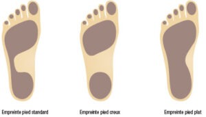 Pied plat et pied plat valgus - Dr Richard Borgi — Chirurgie du pied et ...