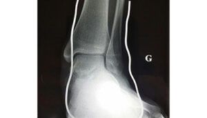 Pied plat et pied plat valgus - Dr Richard Borgi — Chirurgie du pied et ...
