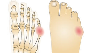 Quintus Varus - Dr Richard Borgi — Chirurgie du pied et de la cheville