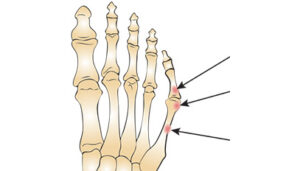 Quintus Varus - Dr Richard Borgi — Chirurgie du pied et de la cheville