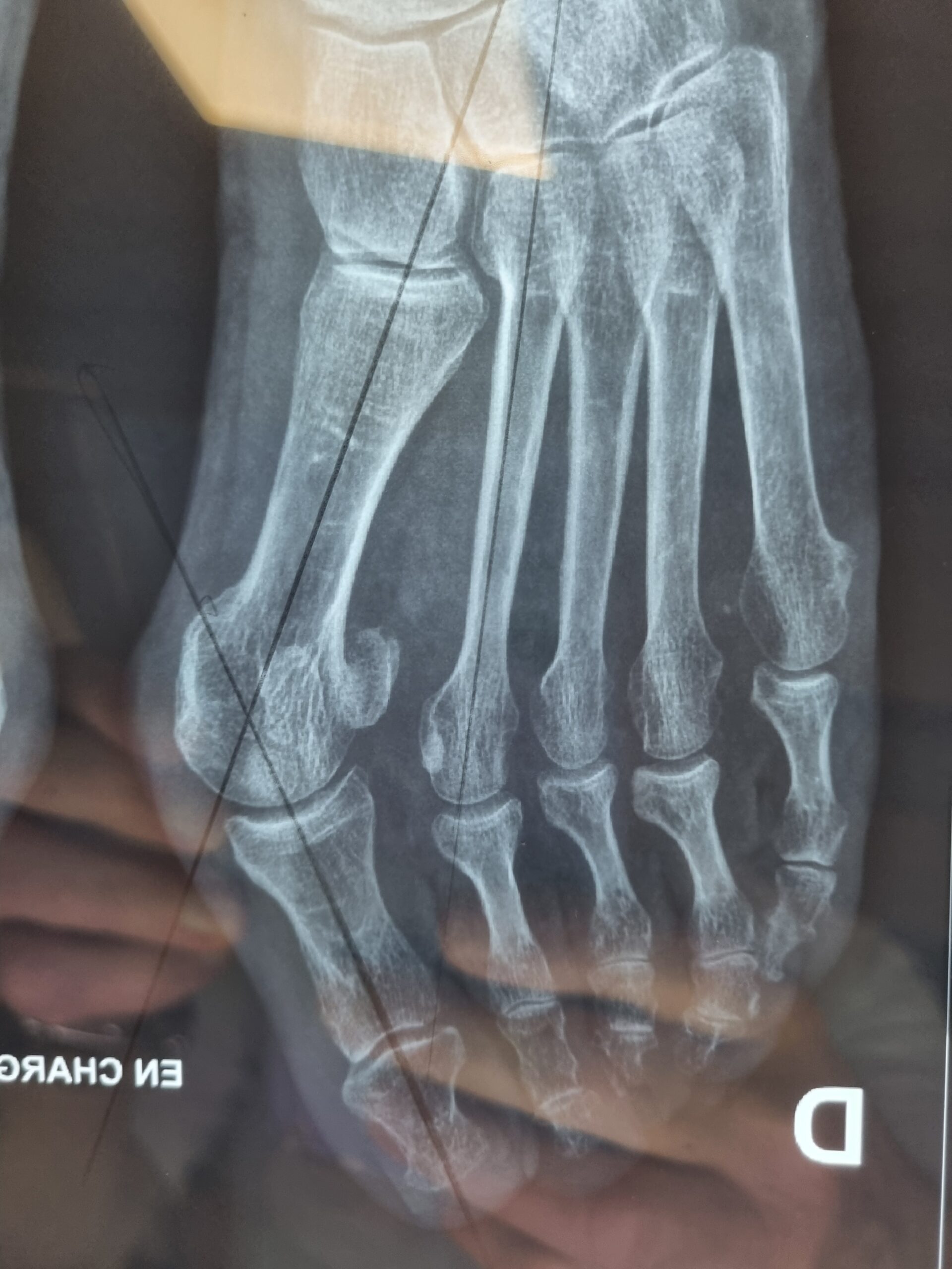 Comment prévenir et ralentir l’évolution de l’hallux valgus ? - Dr ...