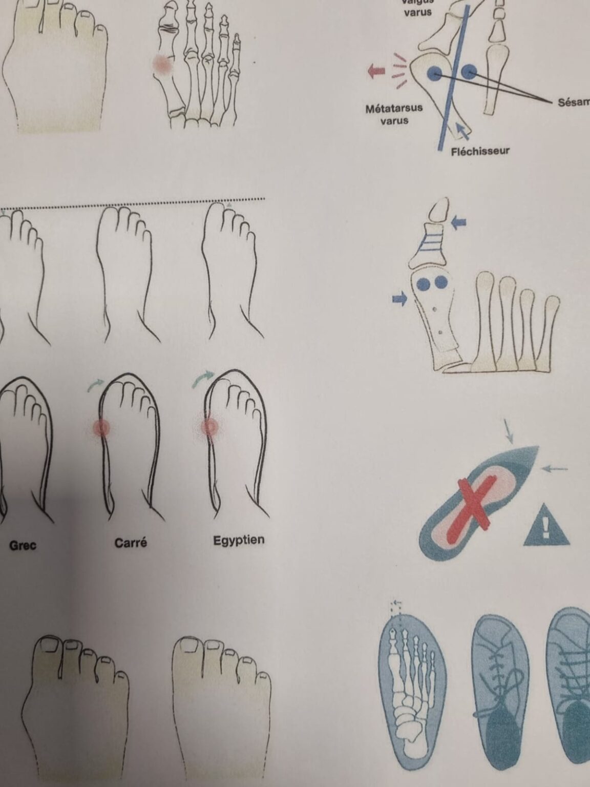 Comment prévenir et ralentir l’évolution de l’hallux valgus ? - Dr ...