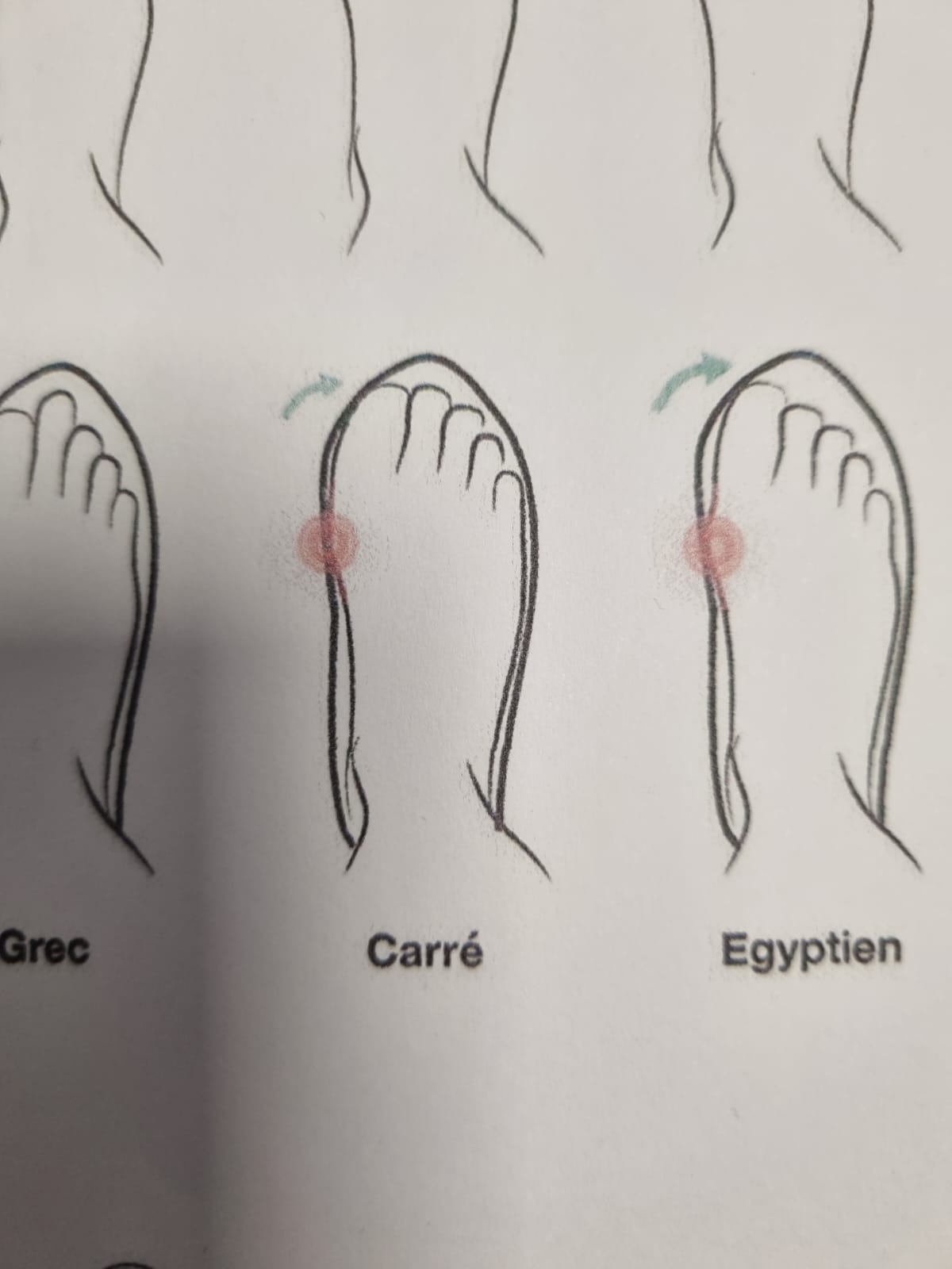 Comment prévenir et ralentir l’évolution de l’hallux valgus ? - Dr ...
